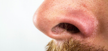 Pimples in the nose: causes and how to get rid of them - Techzle